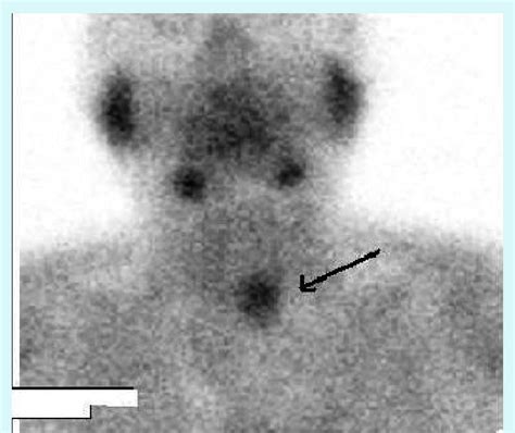 Tc 99m Mibi Parathyroid Scintigraphy Revealed A Parathyroid Adenoma In