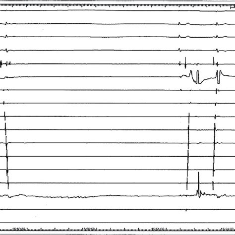 Cessation Of Atrial Flutter After Radiofrequency Ablation And