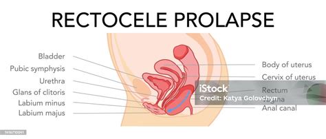 탈출 직장 여성 생식 시스템 자궁 다이어그램 비문과 함께 컷의 측면보기 인간 해부학 내부 장기 플랫 스타일 아이콘입니다 벡터 의료 일러스트 컬러 컨셉 절연 0명에 대한 스톡