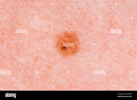 Close Up Of A Junctional Naevus Mole On The Skin In A 36 Year Old