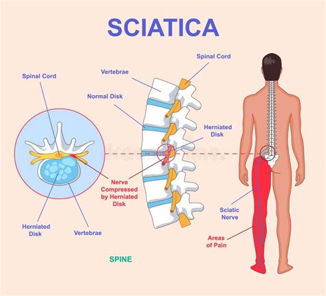 Sciatica Medical Diagram Anatomical Scheme With Human Spine Nerves And Intervertebral Disc