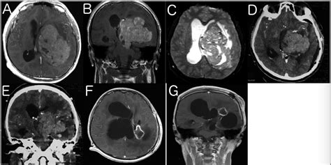 Drainage Pembedahan Menginduksi Subgaleal Hematom Dan Nekrosis Pada