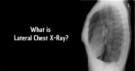 Lateral Chest X Ray