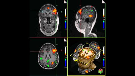 Fmri Brain