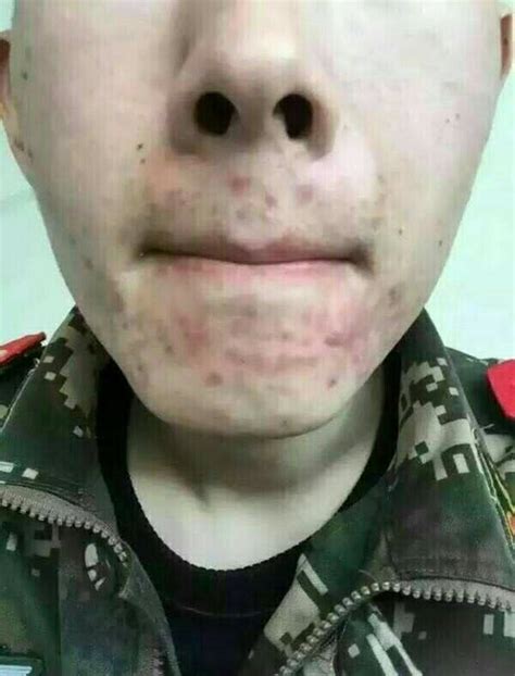 红色痘印怎么消除 红色痘印用什么药膏 随意云