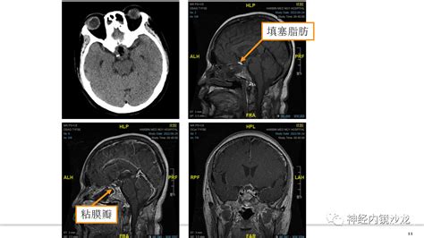 【病例】内镜经鼻经鞍结节蝶骨平台入路切除颅咽管瘤（附视频） 脑医汇