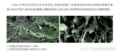 封神ADM H鼻基底填充术告别面部土气 知乎