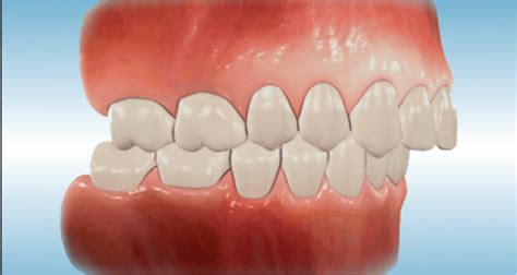 Overjet And Overbite In Adult Teeth Causes And Orthodontic Treatments
