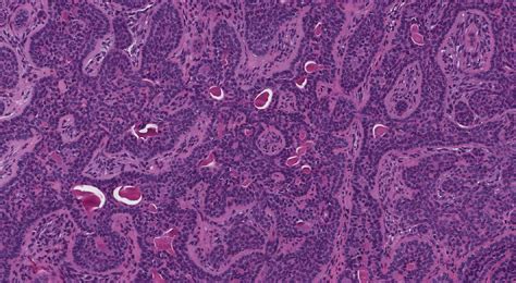 Basal Cell Adenoma Of The Salivary Glands Mypathologyreport