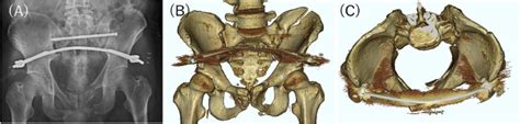 Advancements In Pelvic Ring Fracture Surgery Assessing Infix Screw