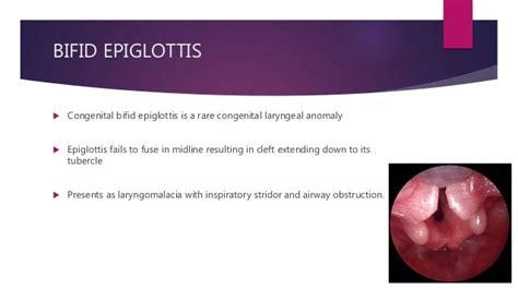 Congenital Anomalies Of The Larynx