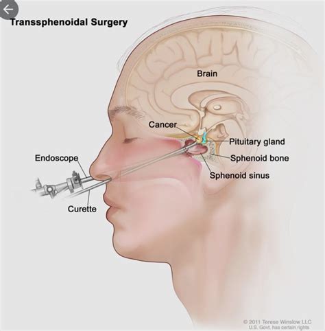 Tratamento Adenoma De Hipófise Porto Alegre Neurocirurgia Ceanne