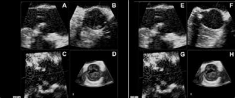Figure 1 From Comparison Of Aortic Root Dimensions And Geometries Pre