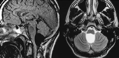 Sagittal Uid Attenuated Inversion Recovery FLAIR Left And Axial T