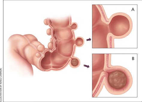 Diagnosis And Management Of Acute Diverticulitis