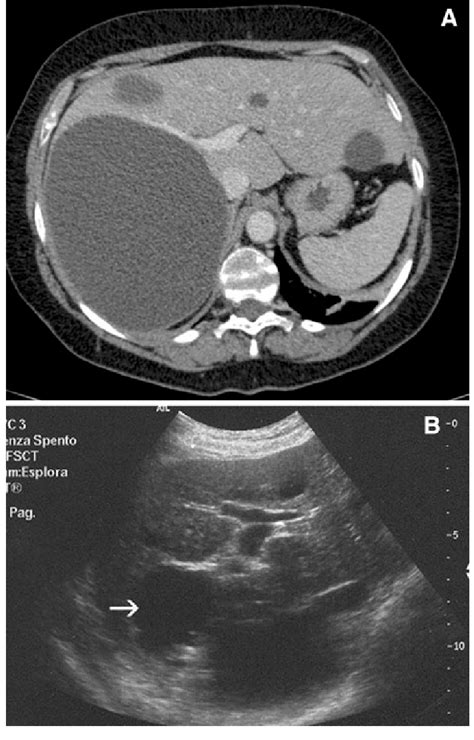 A Computed Tomography Ct Scan Of A 51 Year Old Woman With Polycystic