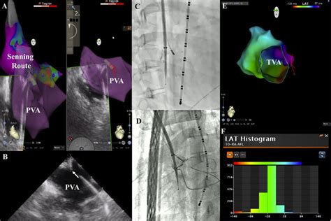 Figure Mapping Of The Pulmonary Venous Atrium A A Sound Star Image