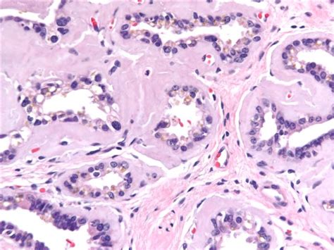 Pathology Outlines Amyloid