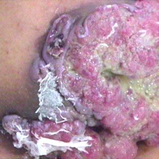 Perianal Mass Two Years Later From Initial Visiting Huge Multinodular Download Scientific