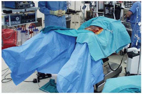 Single Incision Laparoscopic Total Abdominal Colectomy With End