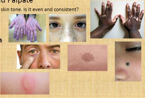 Integumentary Assessment And Skin Integrity Lecture Flashcards Quizlet