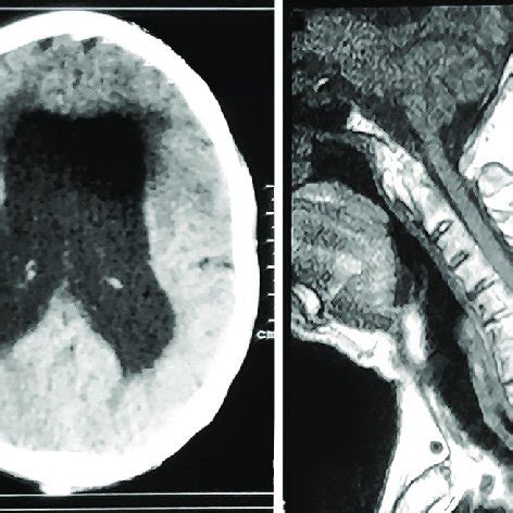 Left Side Noncontrast Computed Tomography NCCT Head Axial Cut