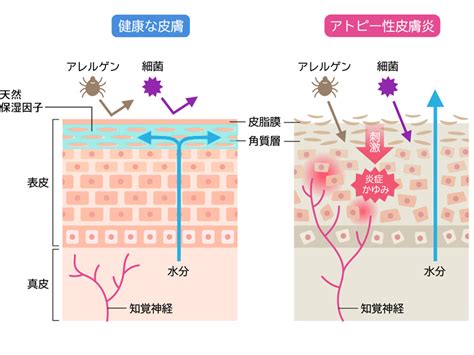 アトピー性皮膚炎の要因どうしてなるのか 患者家族の方へ 認定NPO法人アレルギー支援ネットワーク
