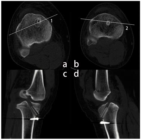 Medicina Free Full Text Anterior Screw Insertion Results In Greater Tibial Tunnel