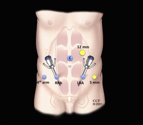 Robotic and Laparoscopic High Extended Pelvic Lymph Node Dissection ...