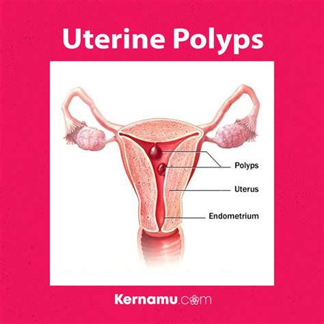 Kebanyakkan Wanita Yang Mempunyai Polyp Tidak Mempunyai Apa Apa