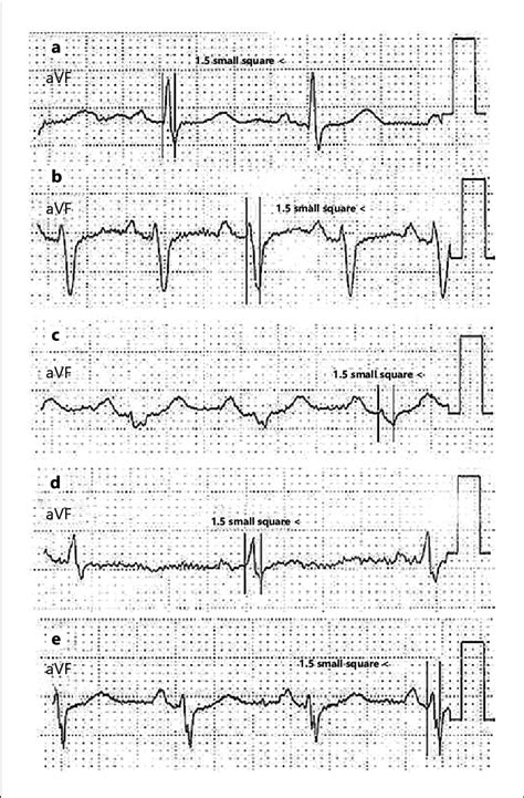 A E Measurement Of Rs Time In Five Different Copd Patients With Rv