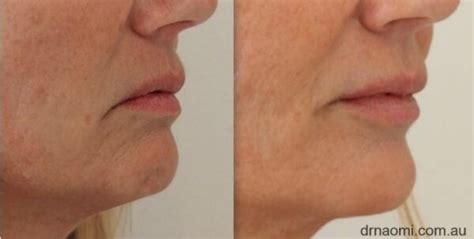 Dermal Filler To Improve Jowls Jawline And Sag In Lower Face Best