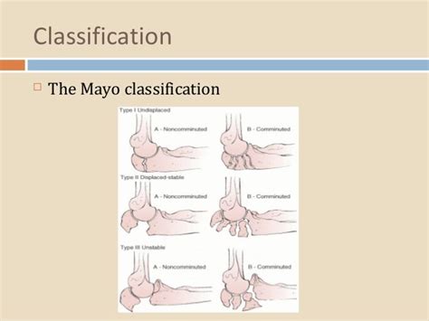 Olecranon Fracture Olecranon Fracture