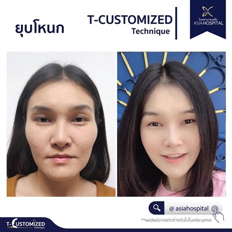 🤷‍♀️สวย เป๊ะ ลงตัว เสริมจมูก เอเชียคลีนิก หมอทนงศักดิ์