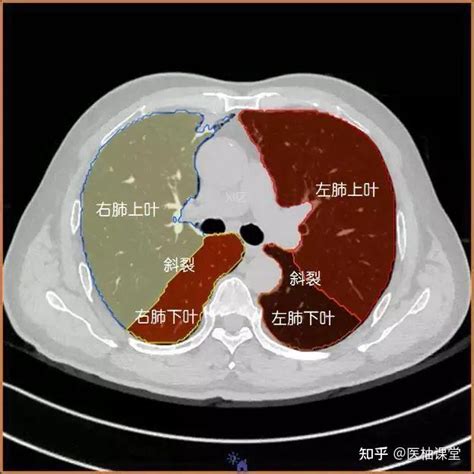非常详细的肺部影像解剖 知乎