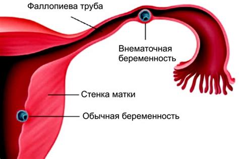 Внематочная беременность причины симптомы тест операция фото