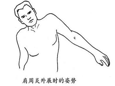肩周炎病发肌肉粘连疼痛难忍 怎么办