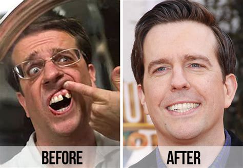 21 Celebrity Dental Implants And Veneers Before And After
