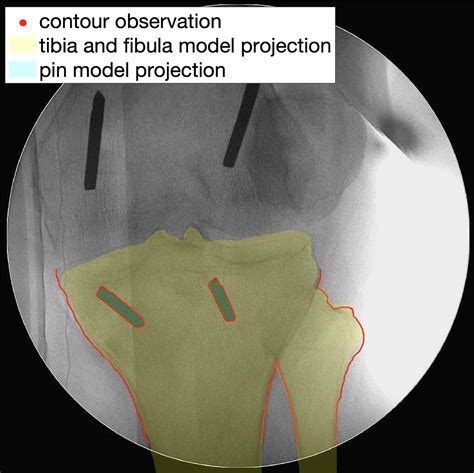 Slam Tka Real Time Intra Operative Measurement Of Tibial Resection
