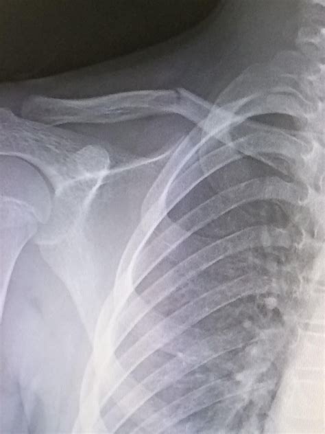 X Ray Broken Bones