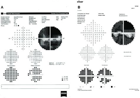 Image Depicting The Visual Field Printout Of Humphrey Field Analyzer