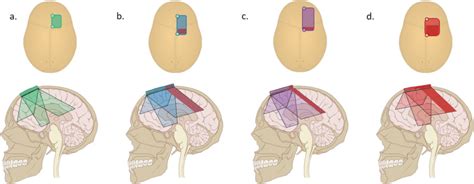 Examples Of Craniotomies For Interhemispheric Approach The Download Scientific Diagram