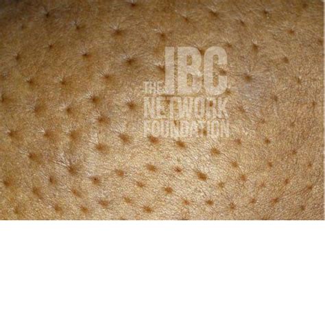 What Causes Orange Peel Skin On Breast At Robert Mulkey Blog