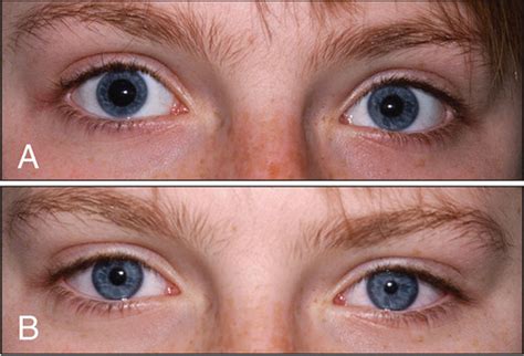 Pinpoint Pupils