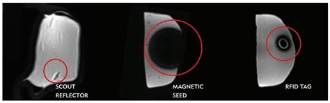 Scout® Radar Localization Tumor Localization Merit Medical