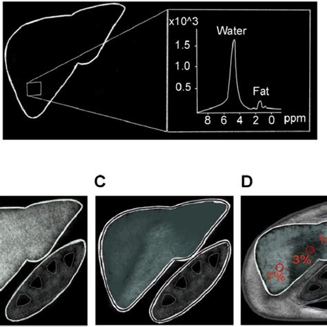 Mr Methods Of Hepatic Fat Assessment A Mr Spectroscopy Calculates The