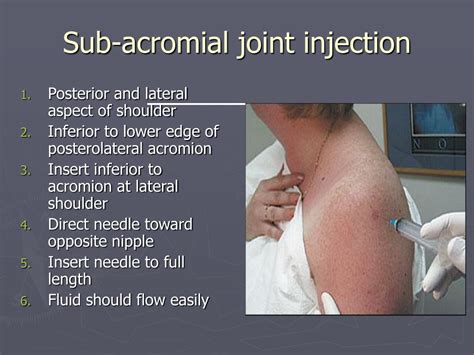 Cortisone Injection Acromioclavicular Joint At Joan Fleming Blog