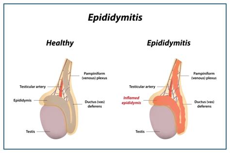 Risk Factors And Precautions For Swollen Testicles Ask The Nurse Expert