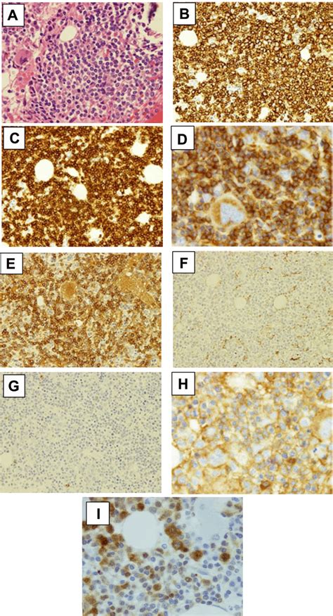 Follow Up Bone Marrow Biopsy Showing The Infiltration By Abnormal