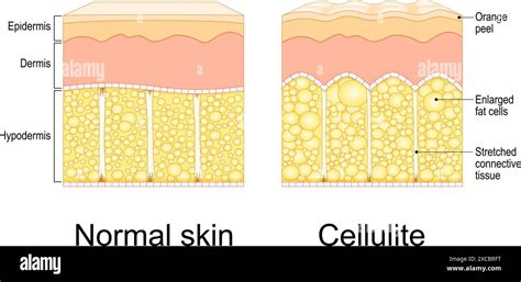Cellulite Formation Orange Peel Syndrome Adiposis Edematosa Cross Section Of Cellulite And